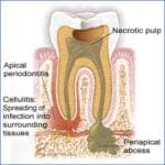 Periapical Abscess | Smiles for Life Oral Health