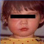 Facial Cellulitis | Smiles for Life Oral Health