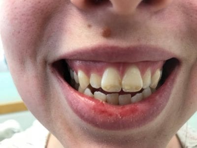 Common Tooth Abnormalities | Smiles for Life Oral Health