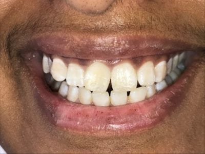 Common Tooth Abnormalities | Smiles for Life Oral Health