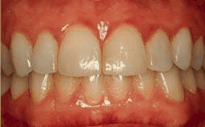 Common Gum Abnormalities | Smiles for Life Oral Health