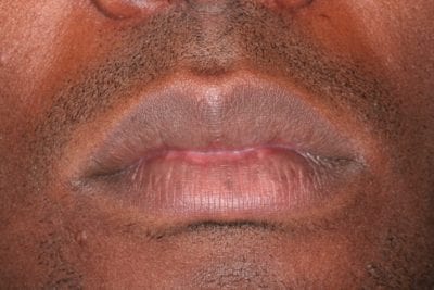 Common Lip Abnormalities | Smiles for Life Oral Health