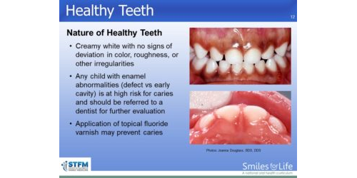 Download Slides – Module 6: Fluoride Varnish | Smiles for Life Oral Health